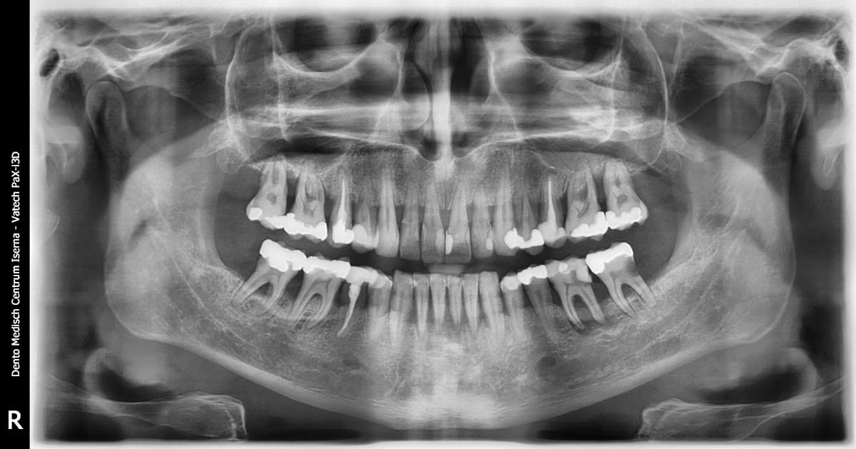 Paradontologie - Tandartspraktijk Iserna
